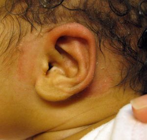EarWell© Deformities - Pediatric Plastic Surgery Institute