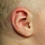 EarWell© Deformities - Pediatric Plastic Surgery Institute