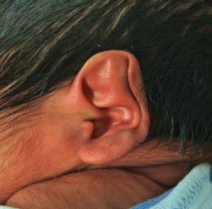 EarWell© Deformities - Pediatric Plastic Surgery Institute