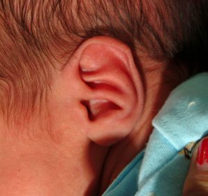 EarWell© Deformities - Pediatric Plastic Surgery Institute